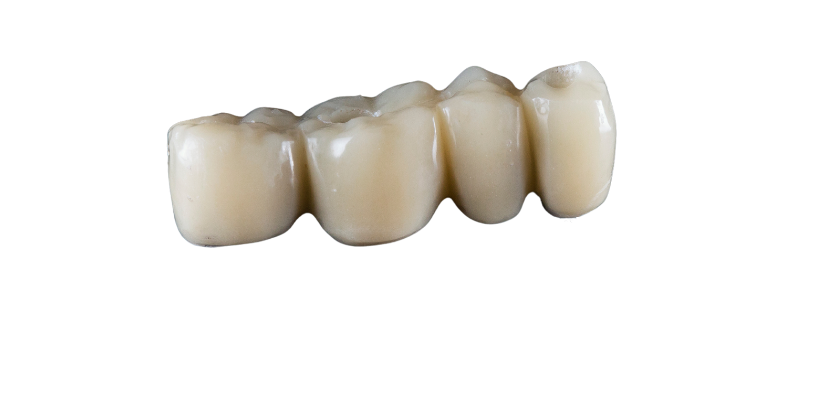 Dente Provisório: Importância e Cuidados